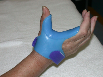 Customized Splints | Helene Boonin: Occupational Therapy Services
