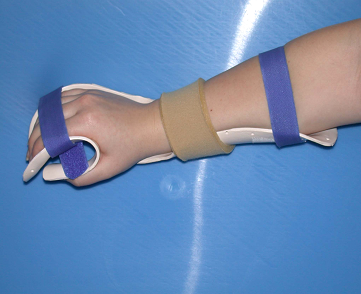 Customized Splints | Helene Boonin: Occupational Therapy Services